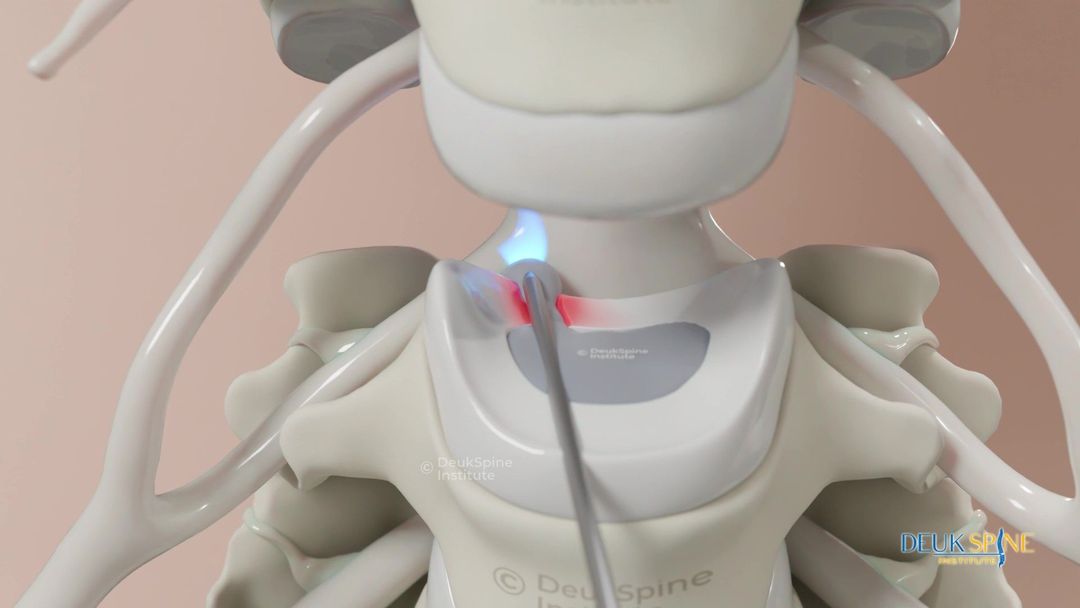 Cervical Deuk Laser Disc Repair Benefits | Deuk Spine