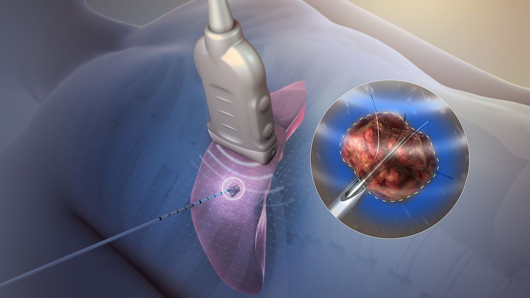 Radiofrequency Ablation: Procedure, Risks & Recovery
