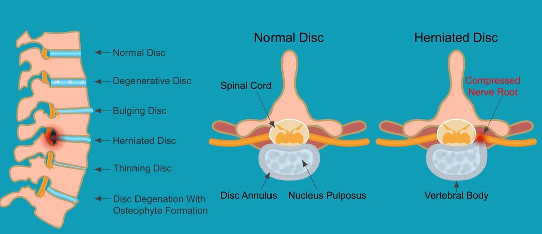 Herniated Disc Symptoms | typically a low back ache