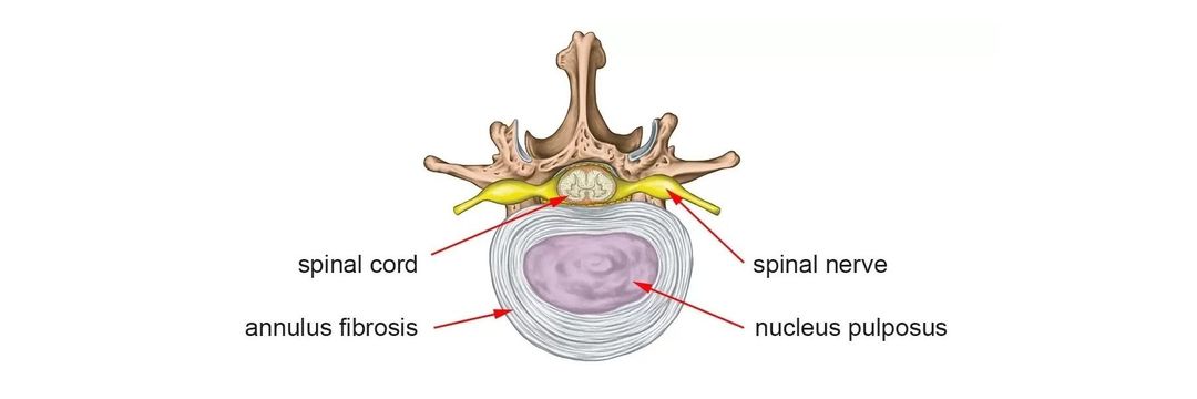 Annular Fissure Assessment and Treatment