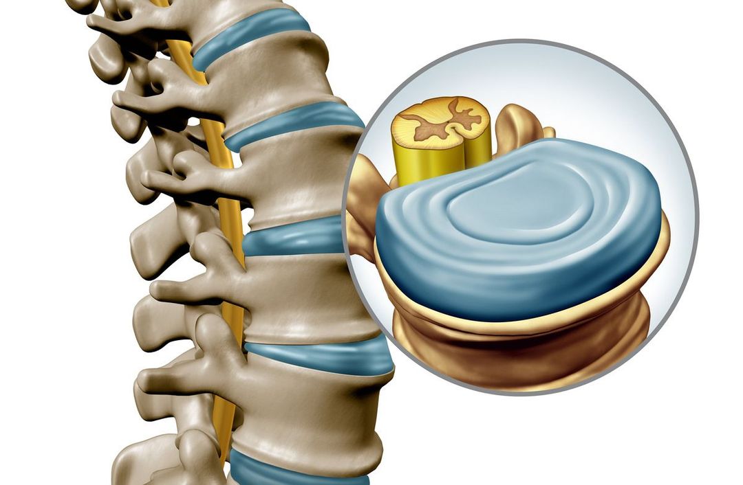 Thoracic Herniated Disc: Symptoms, Diagnosis, And More - Deuk Spine