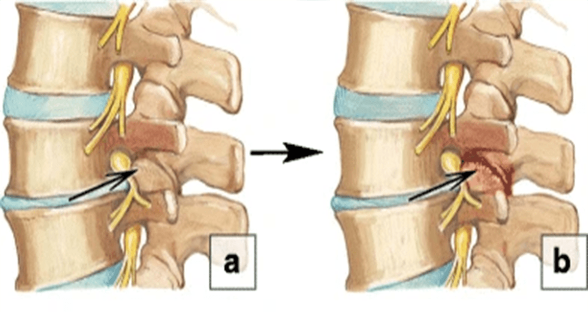 Adjacent Segment Disease Symptoms Deuk Spine