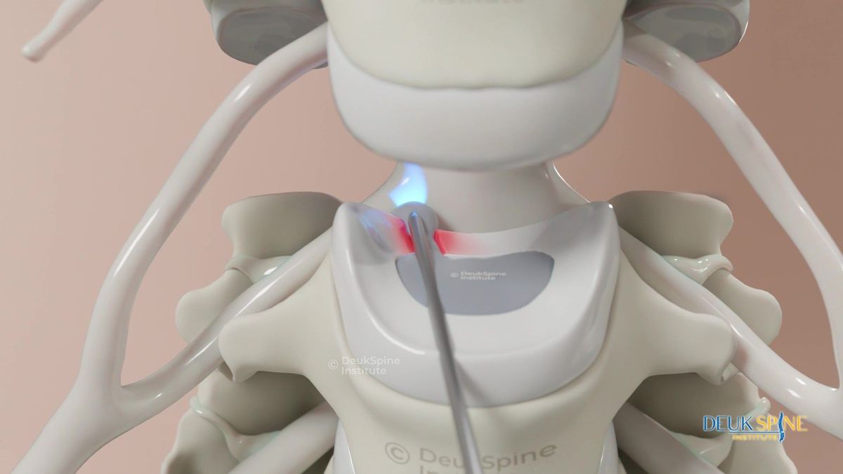 Cervical Deuk Laser Disc Repair Benefits | Deuk Spine
