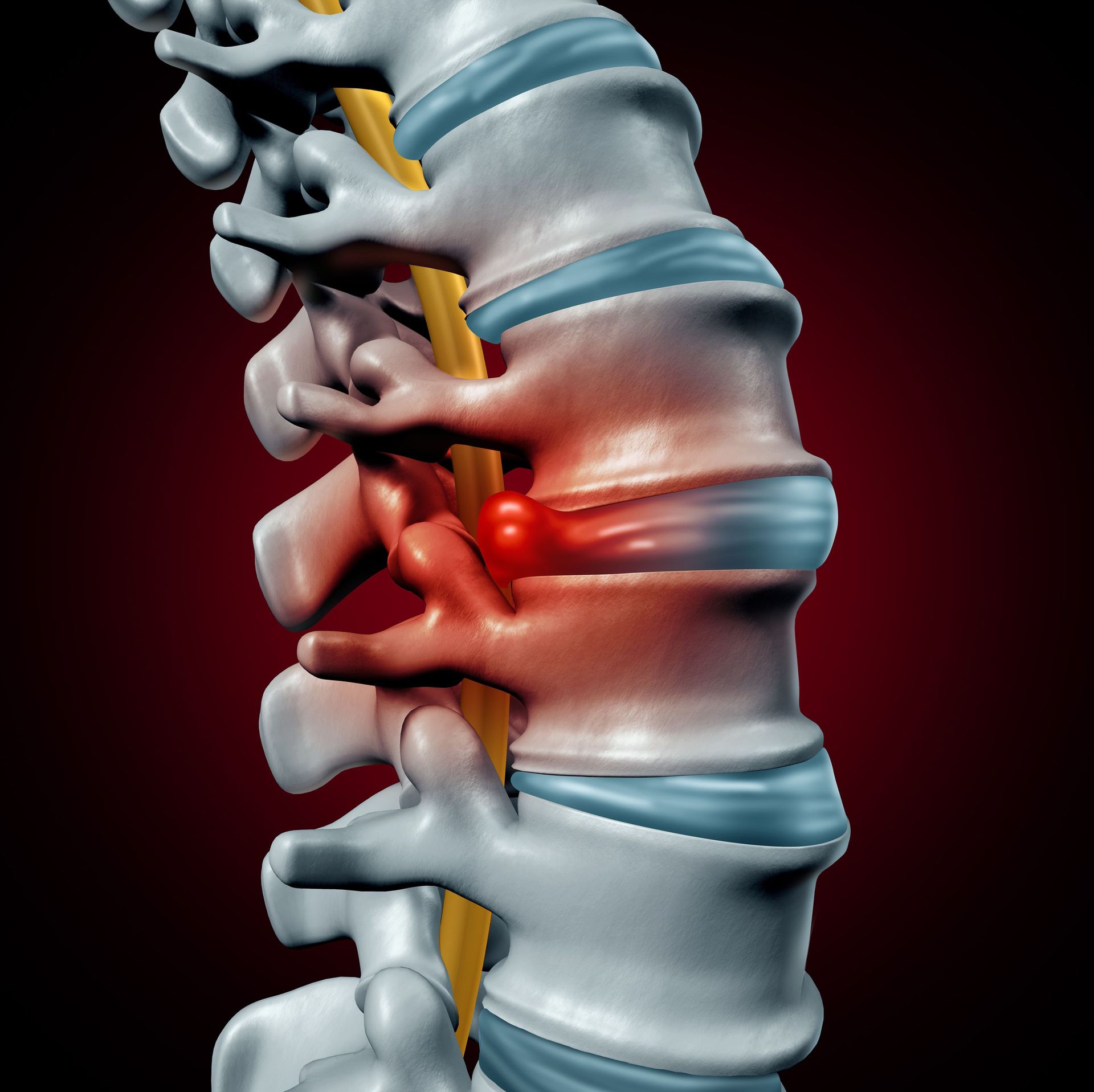 Bulging Disc Treatments and Surgery for Neck and Back