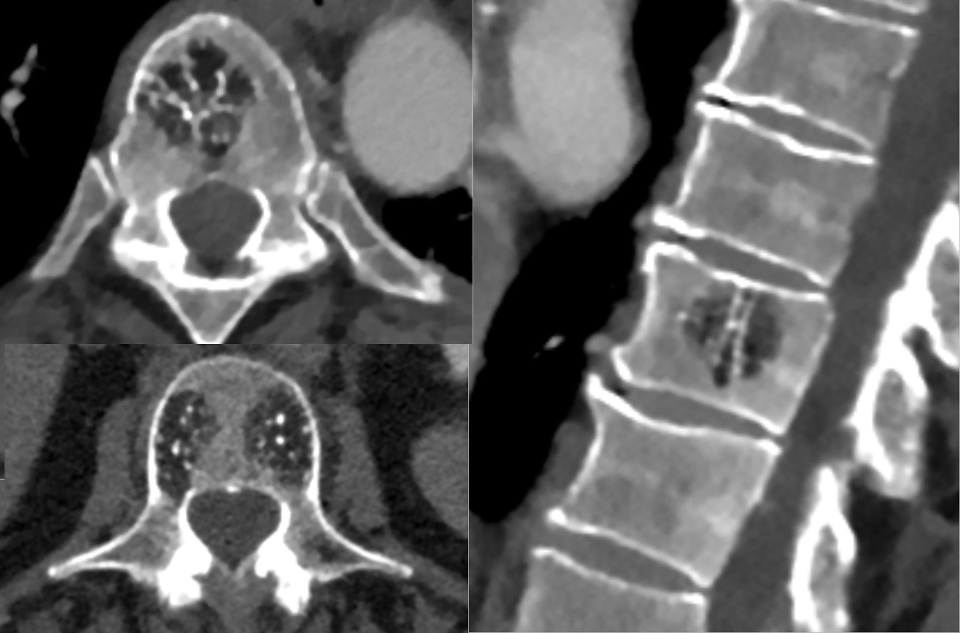 Vertebral Hemangioma Surgical Management Of Symptomatic T8 Vertebral