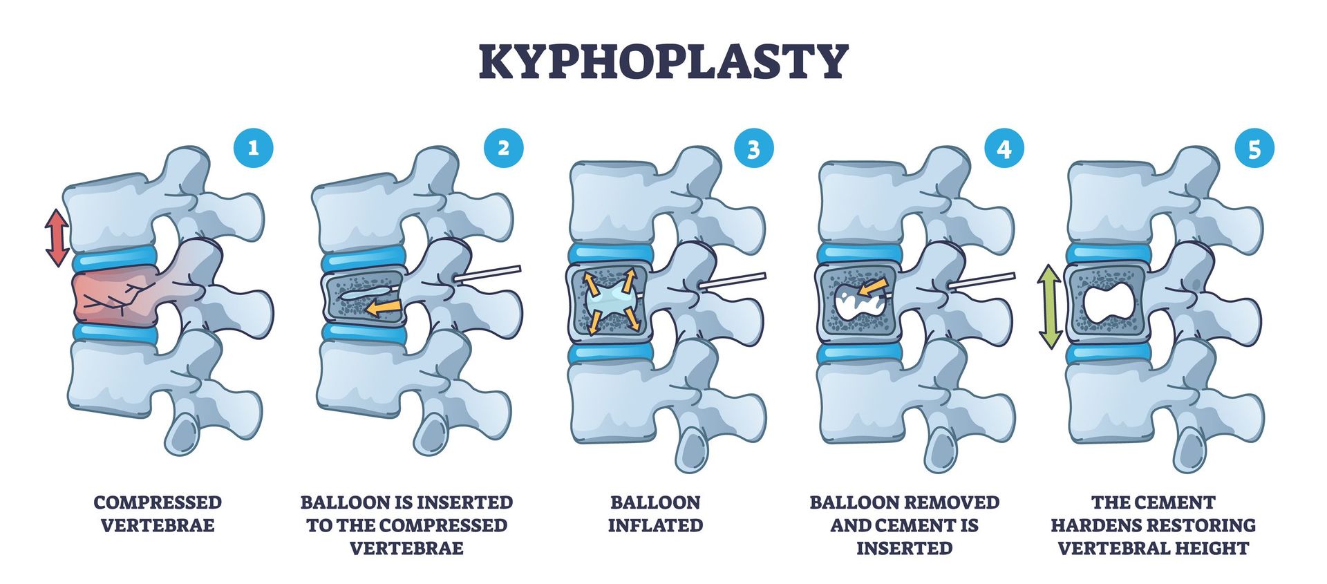 Kyphoplasty Surgery | Spinal Fracture Treatment Central Florida