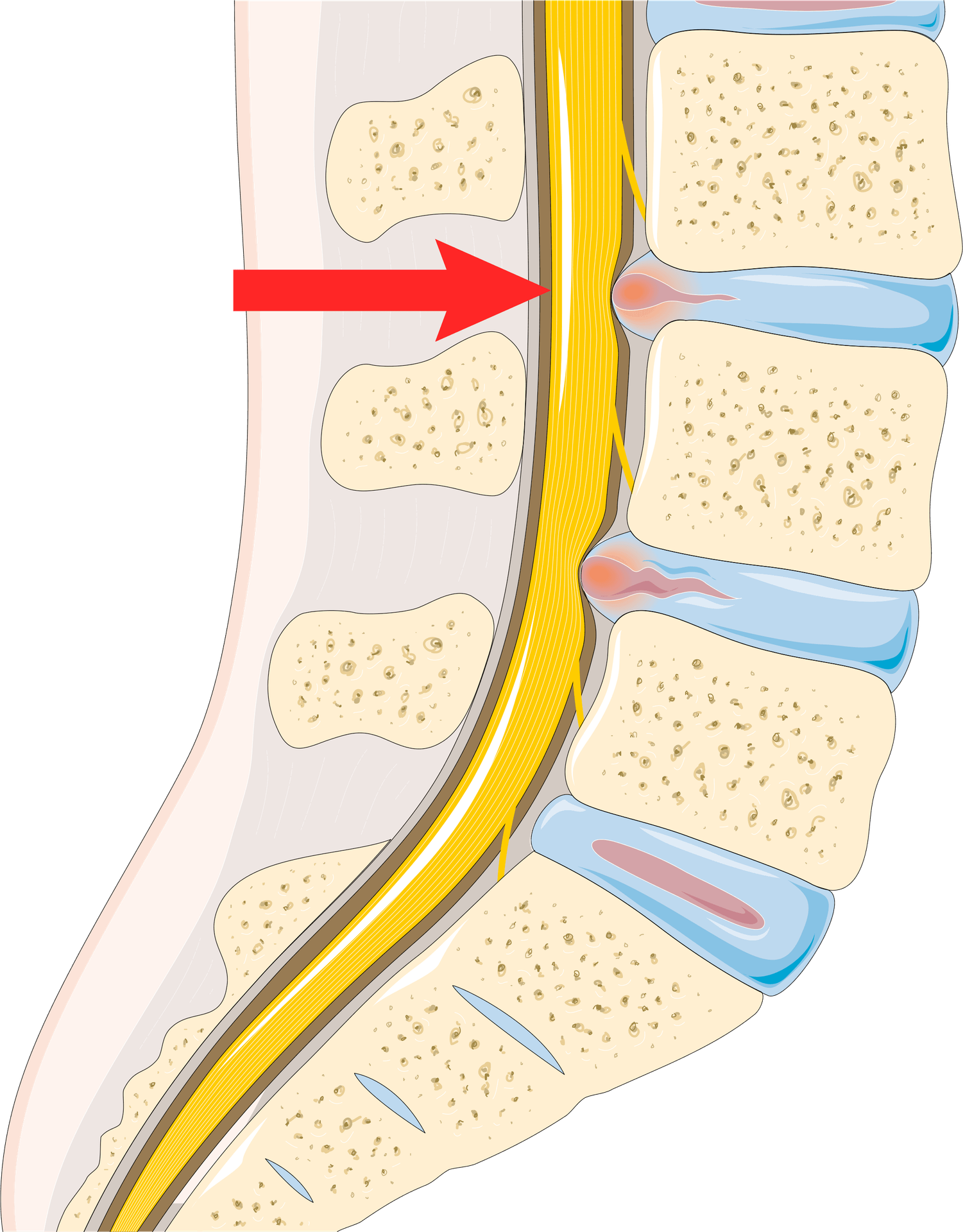 Lumbar L3-L4 disc herniation