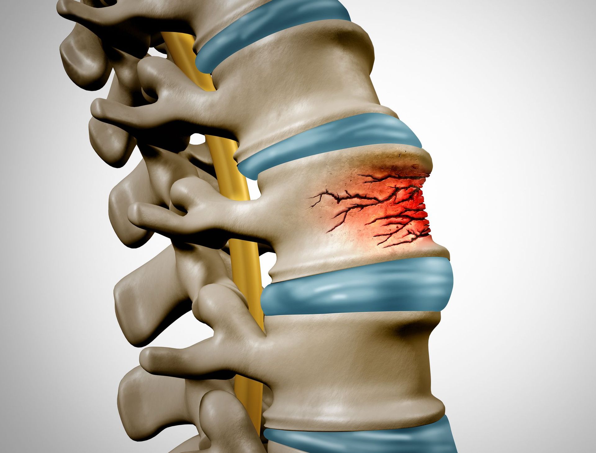 Wedge Fractures: Diagnosis & Treatment | Deuk Spine