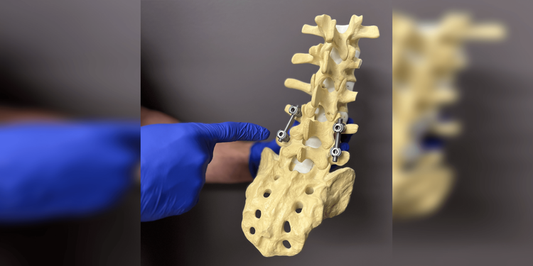 Spinal Fusion - An outdated and dangerous surgery
