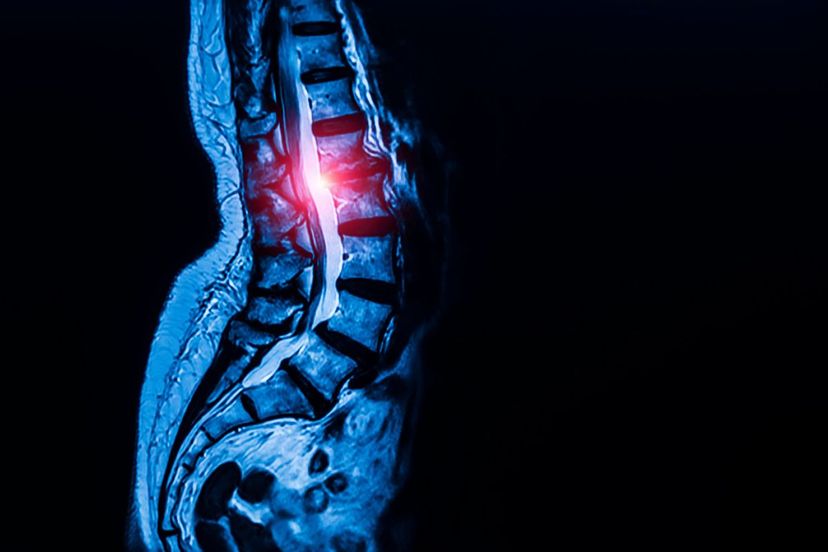 Multilevel Degenerative Disc Disease: Causes, Symptoms & Treatment