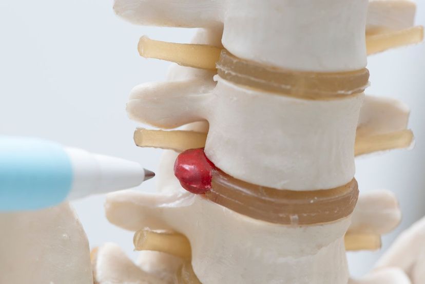 Bulging Disc: Key Differences, Symptoms, And Treatment